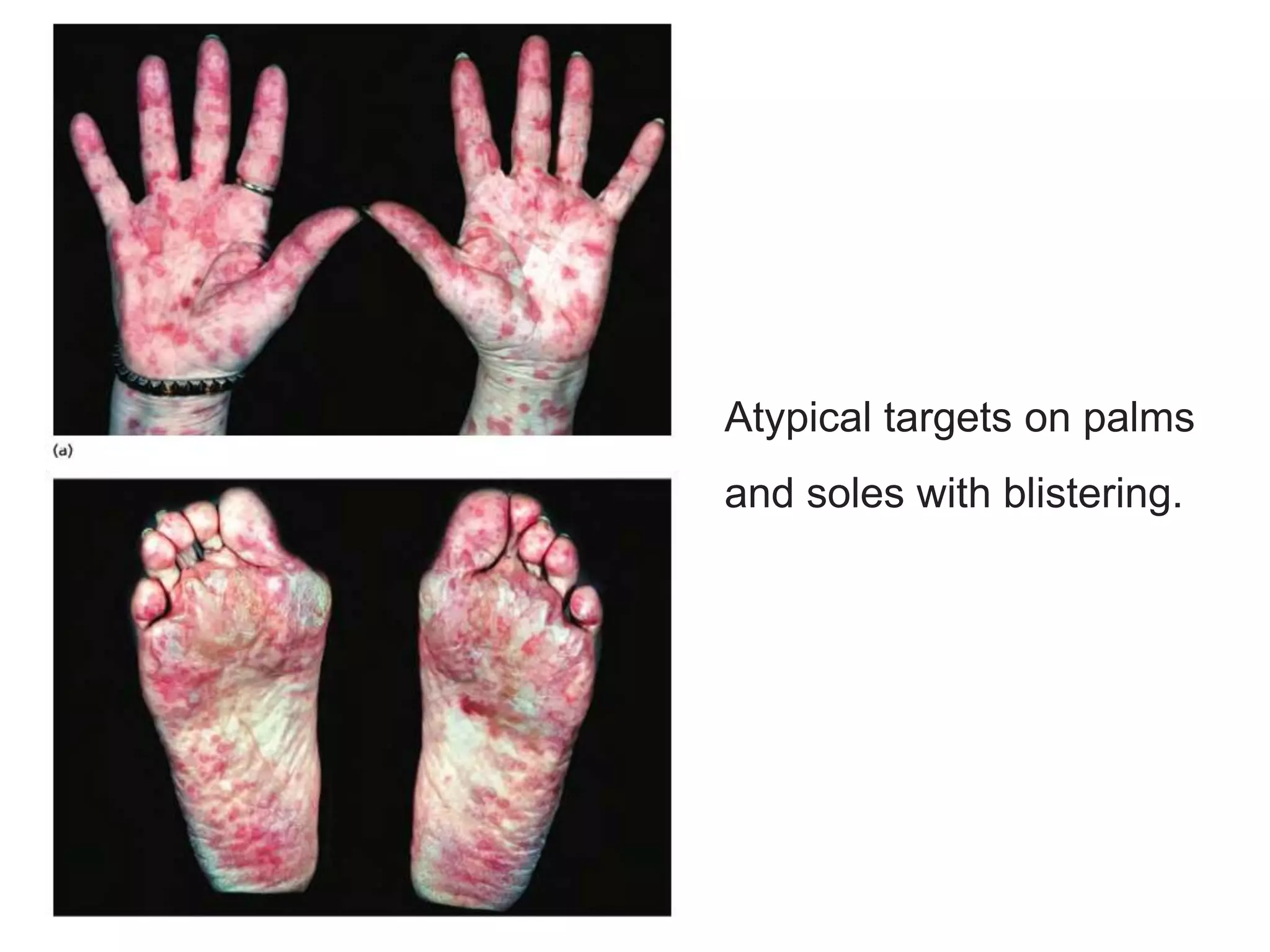 Severe Cutaneous Adverse Reactions to Drugs | PPTX