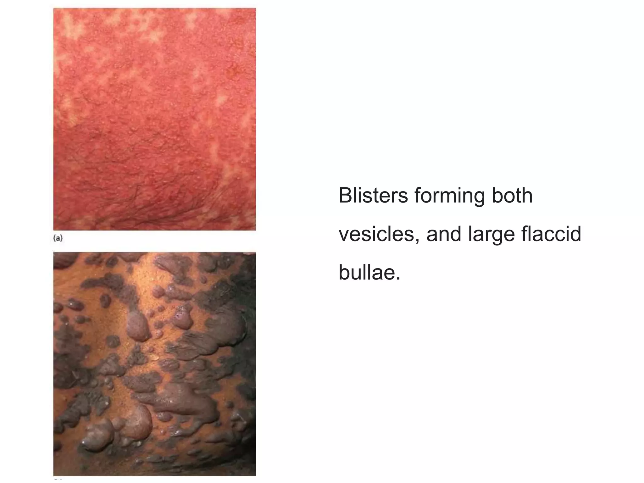 Severe Cutaneous Adverse Reactions to Drugs | PPTX