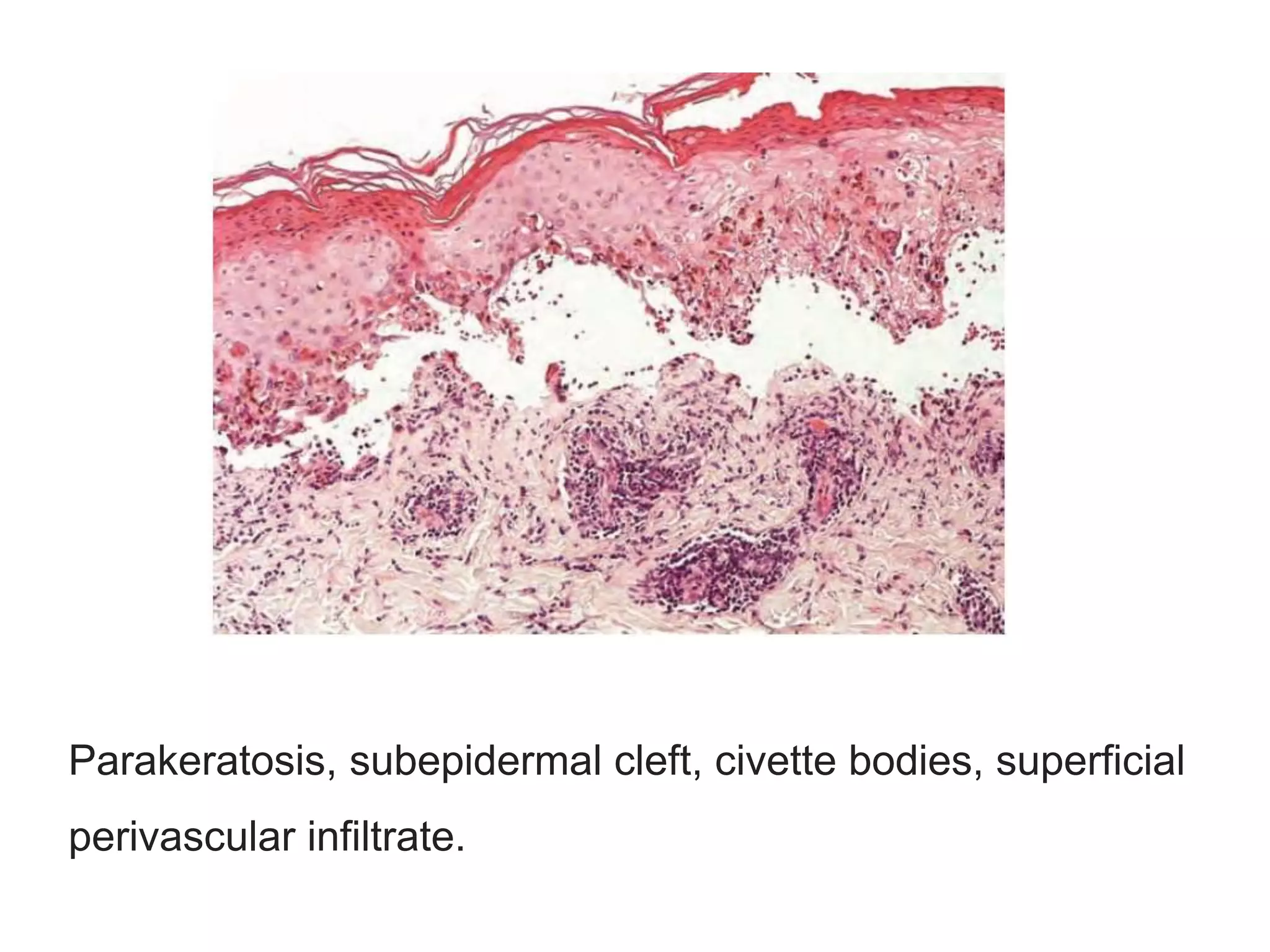 Severe Cutaneous Adverse Reactions to Drugs | PPTX
