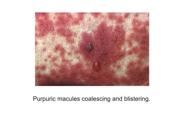 Severe Cutaneous Adverse Reactions to Drugs | PPTX | Skin and ...