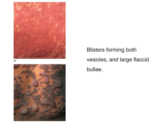 Severe Cutaneous Adverse Reactions to Drugs | PPTX | Skin and ...
