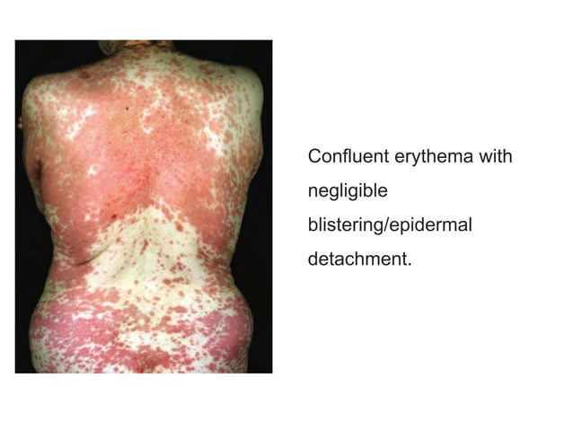 Severe Cutaneous Adverse Reactions to Drugs | PPTX | Skin and ...