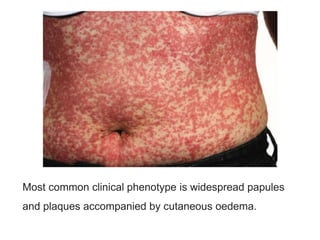 Severe Cutaneous Adverse Reactions to Drugs | PPTX