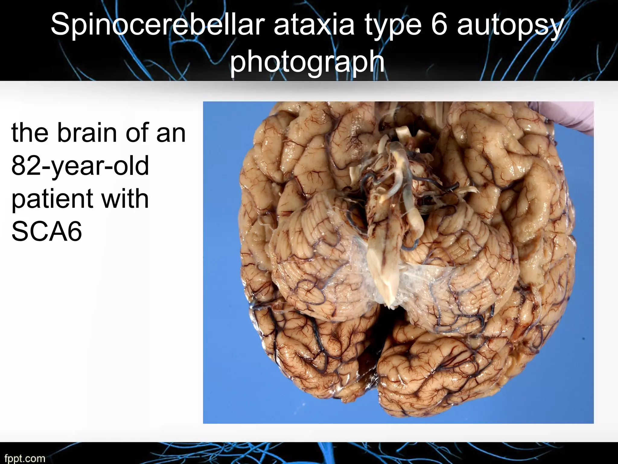 Spinocerbellar Ataxia | PPT