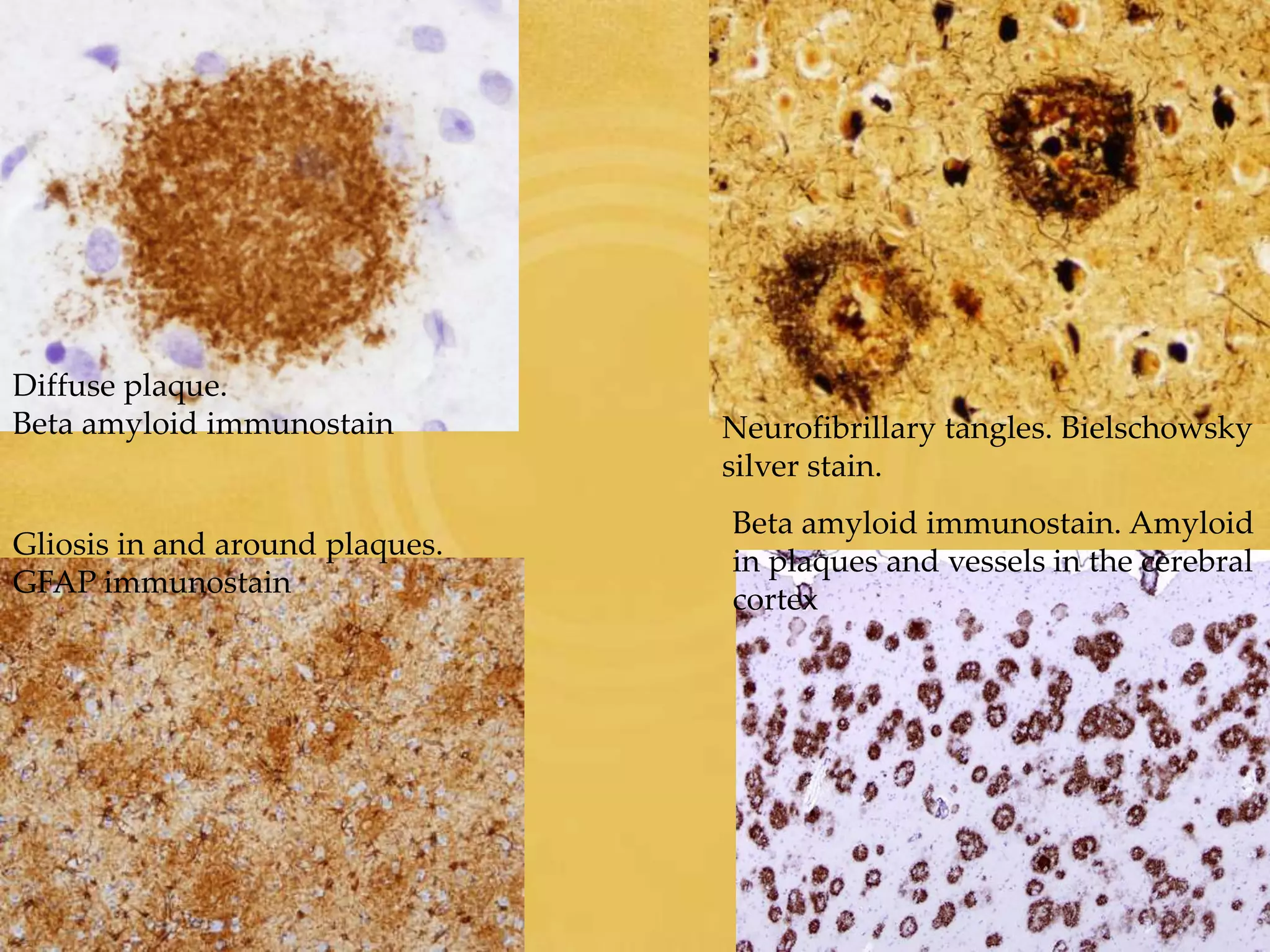 Neurodegenerative disorders | PPTX