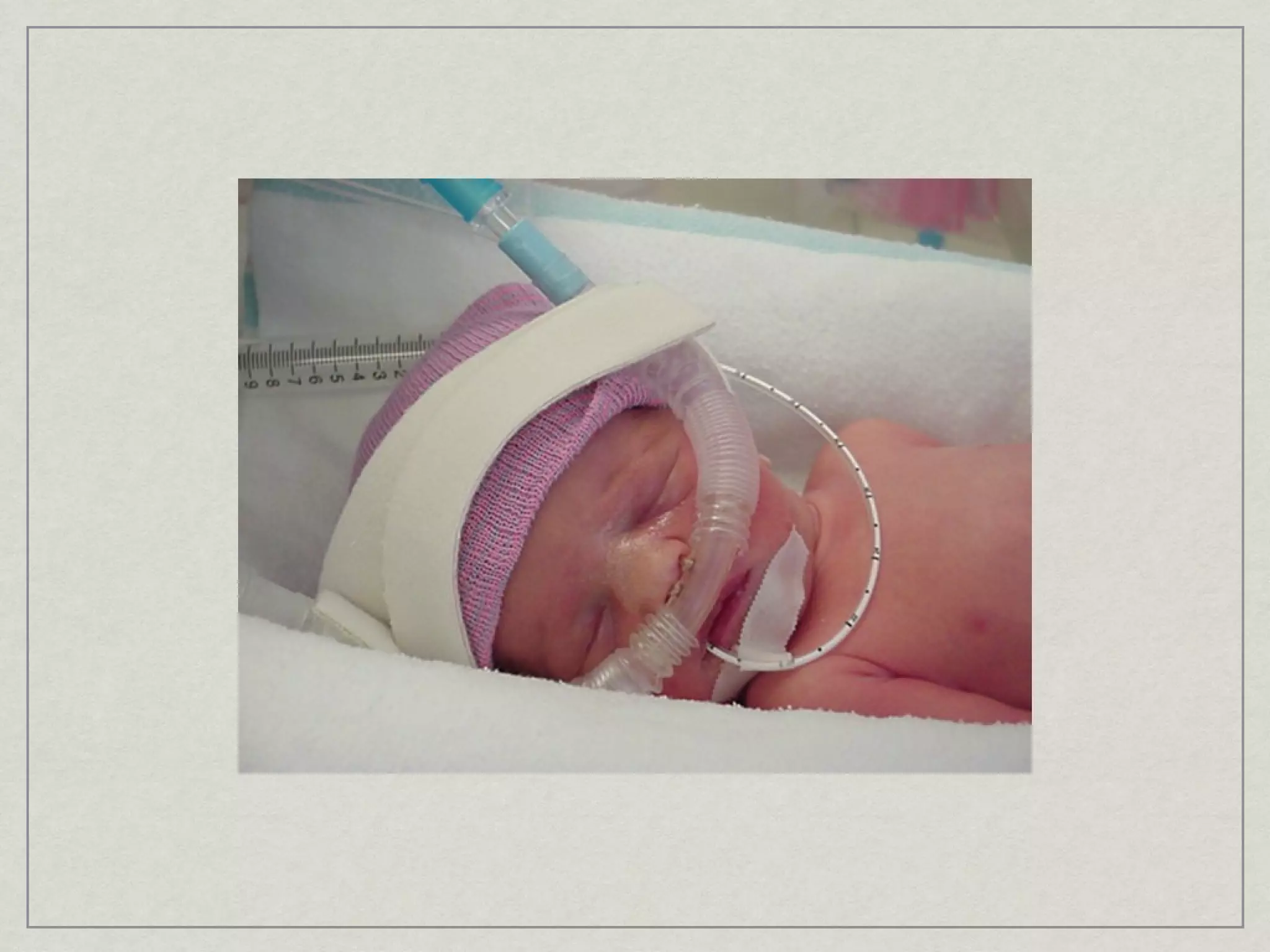 SCBU CPAP DR STEVE WONG | PPT