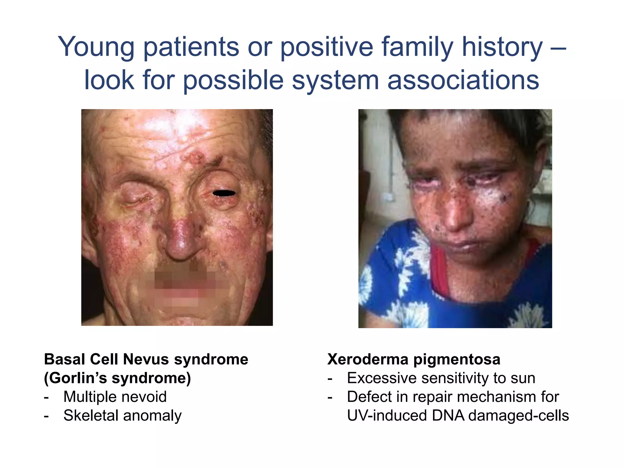 Squamous cell carcinoma, Basal cell carcinoma, Sebaceous gland ...