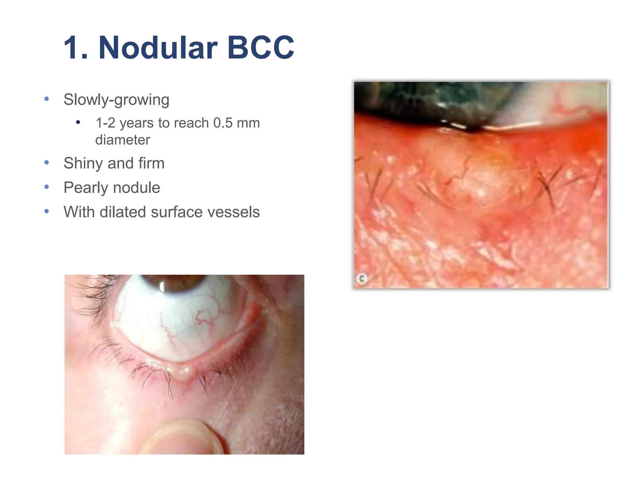 Squamous cell carcinoma, Basal cell carcinoma, Sebaceous gland ...