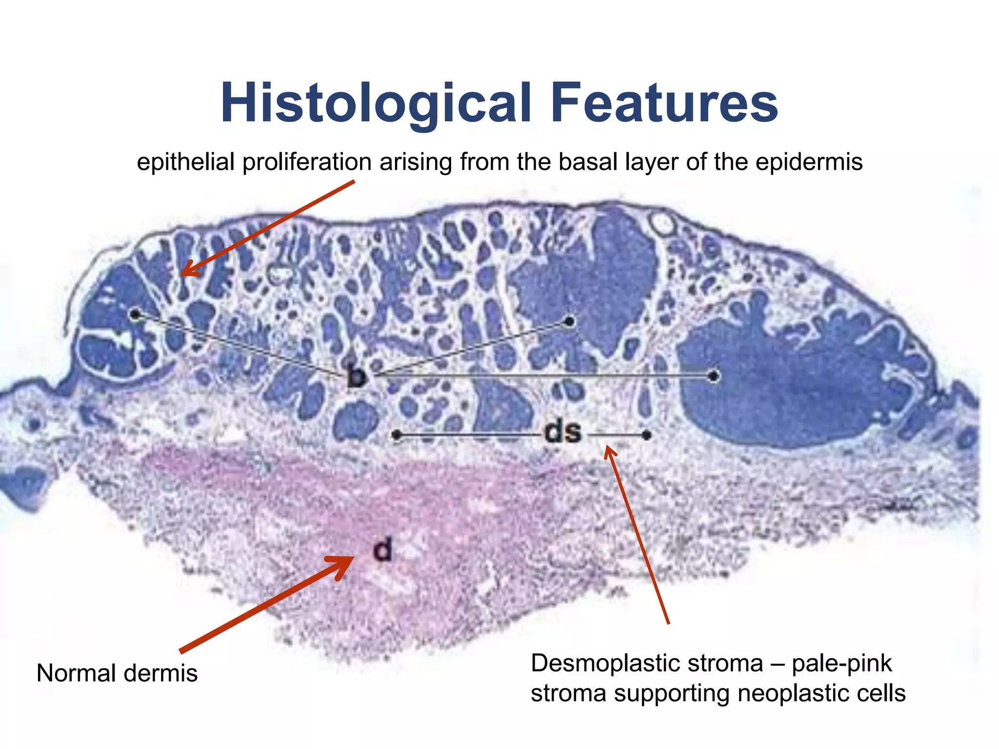 Squamous cell carcinoma, Basal cell carcinoma, Sebaceous gland ...