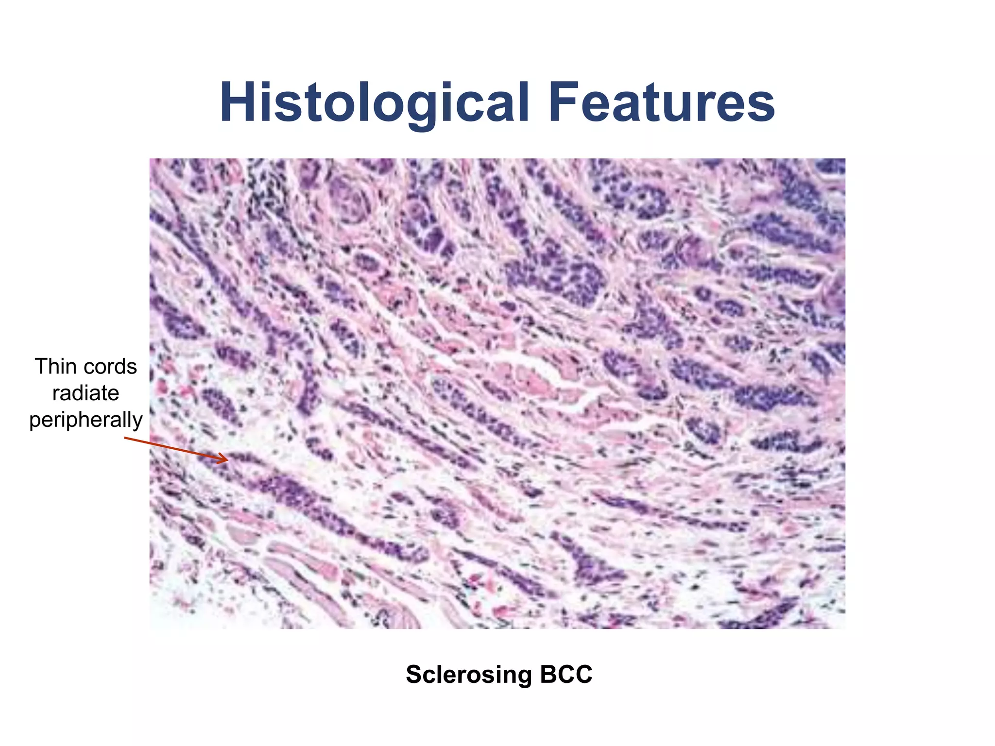 Squamous cell carcinoma, Basal cell carcinoma, Sebaceous gland ...