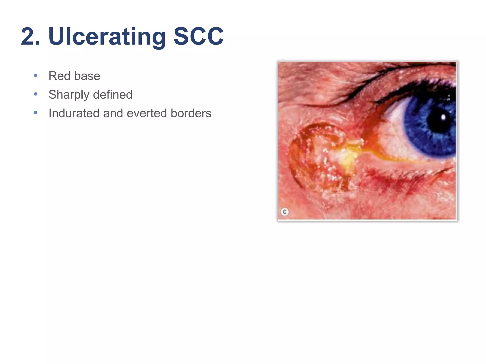 Squamous cell carcinoma, Basal cell carcinoma, Sebaceous gland ...