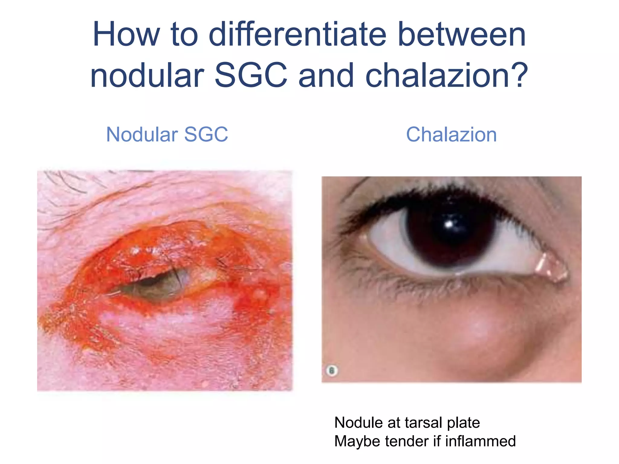 Squamous cell carcinoma, Basal cell carcinoma, Sebaceous gland ...