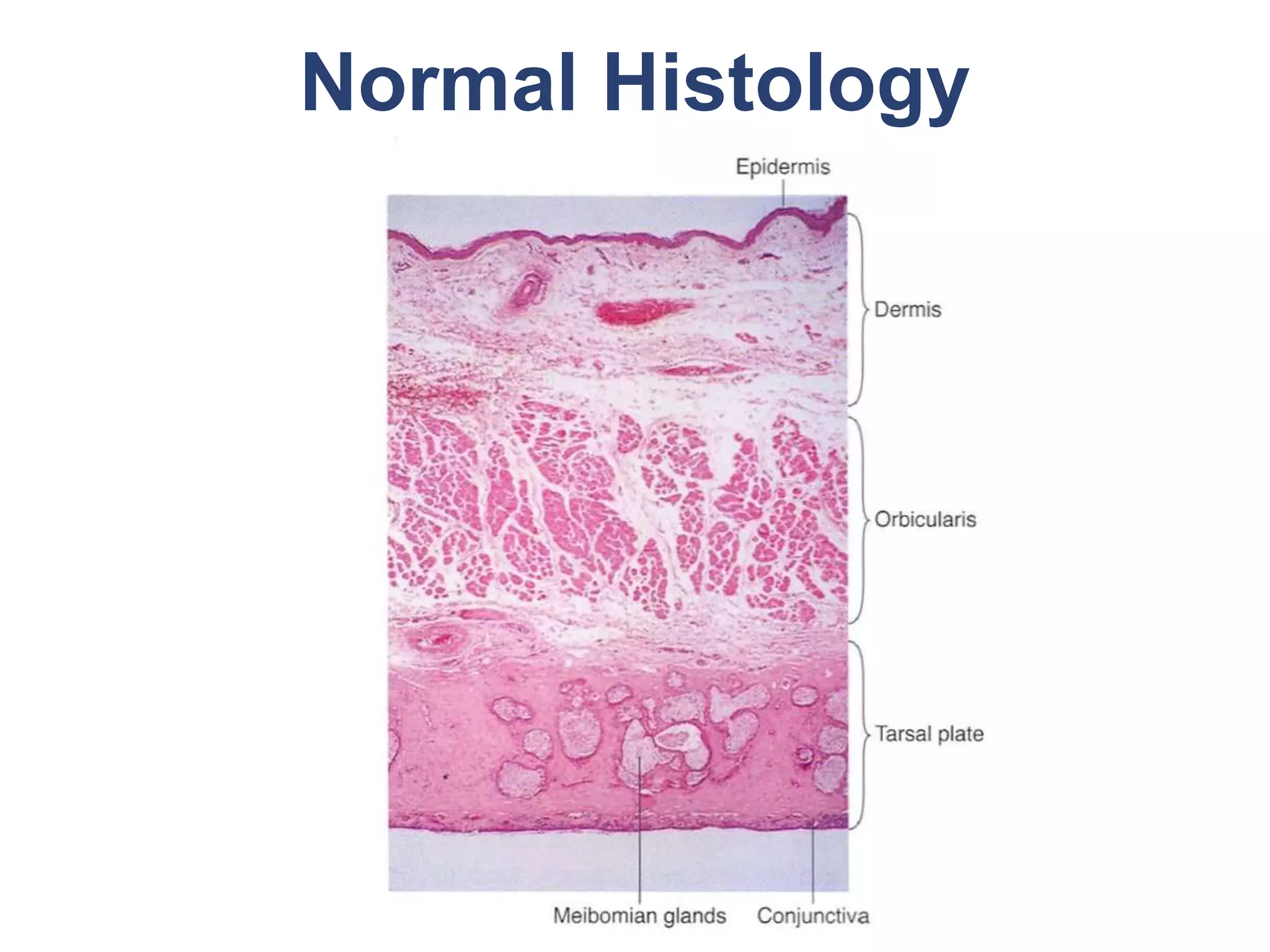 Squamous cell carcinoma, Basal cell carcinoma, Sebaceous gland ...
