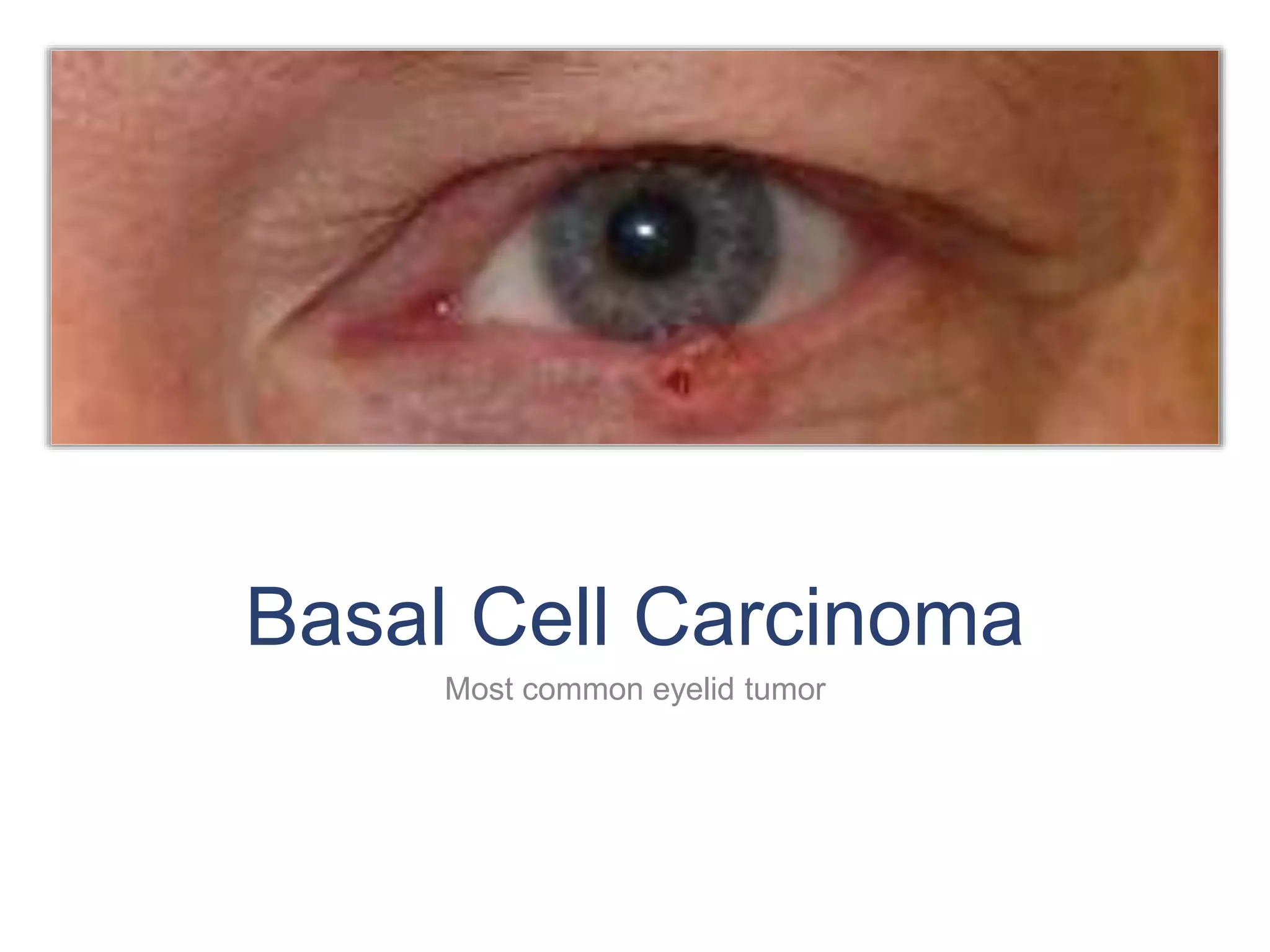 Squamous cell carcinoma, Basal cell carcinoma, Sebaceous gland ...