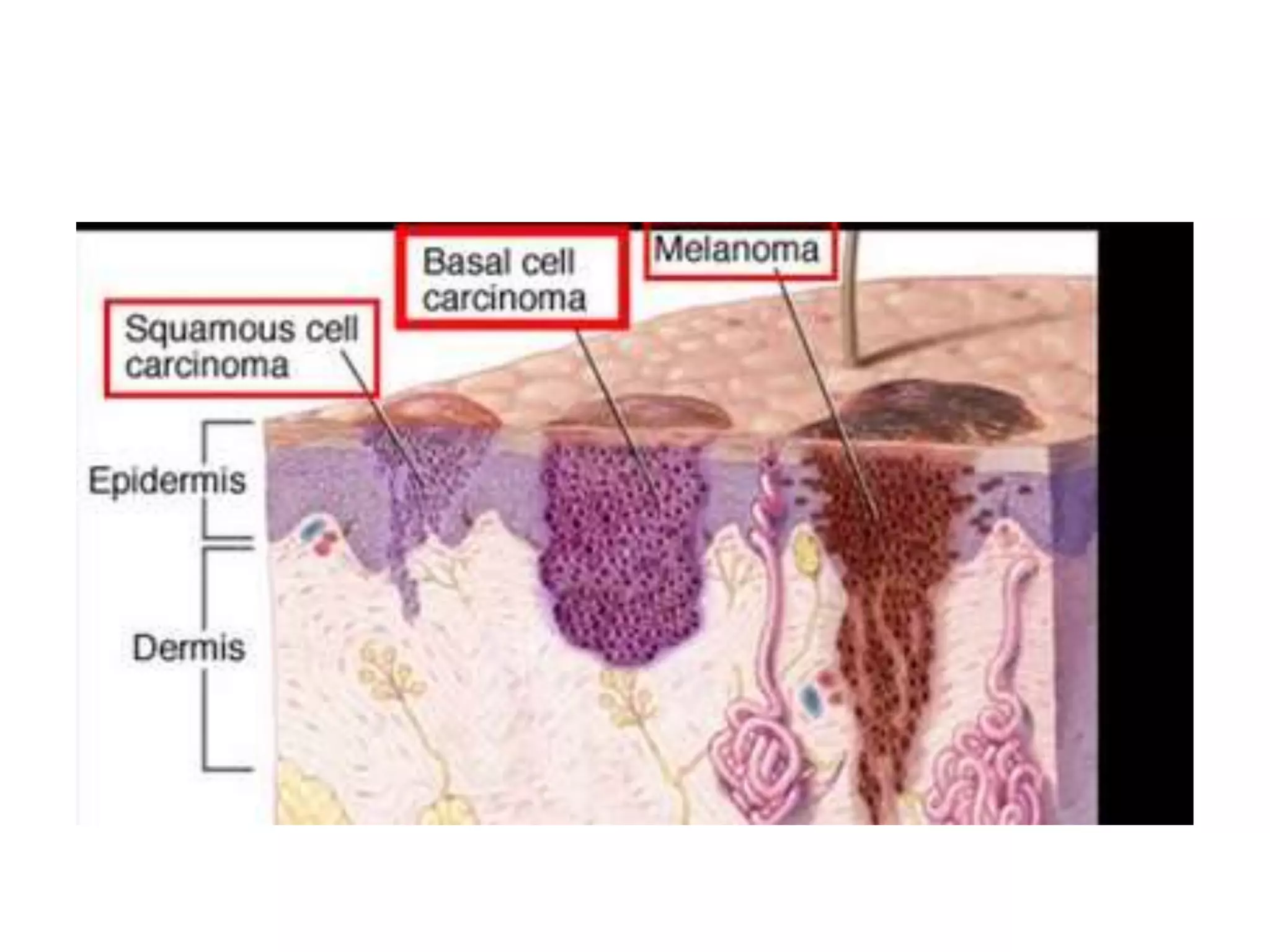 Squamous cell carcinoma, Basal cell carcinoma, Sebaceous gland ...