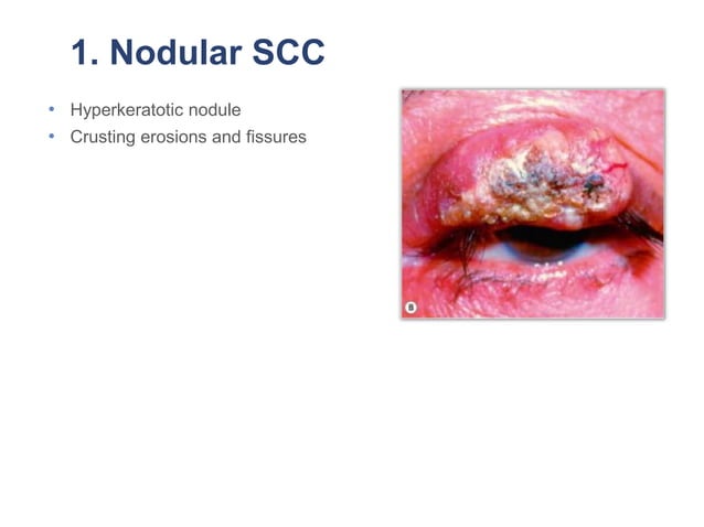 Squamous cell carcinoma, Basal cell carcinoma, Sebaceous gland ...