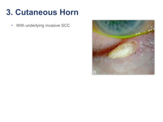 Squamous cell carcinoma, Basal cell carcinoma, Sebaceous gland ...