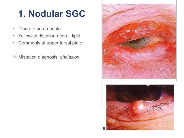 Squamous cell carcinoma, Basal cell carcinoma, Sebaceous gland ...