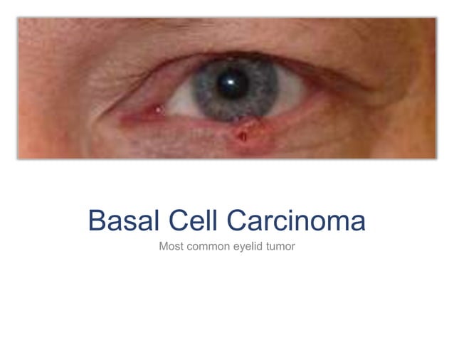 Squamous cell carcinoma, Basal cell carcinoma, Sebaceous gland ...