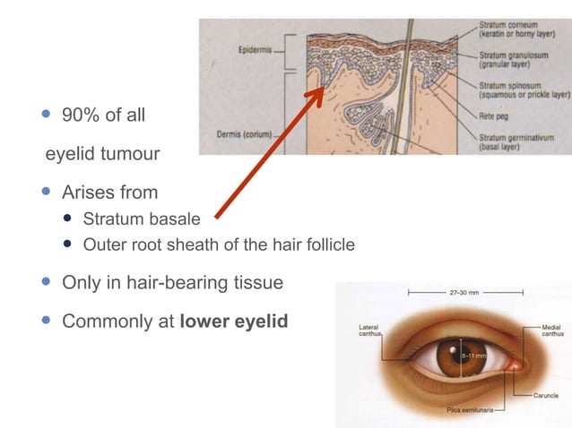 Squamous cell carcinoma, Basal cell carcinoma, Sebaceous gland ...