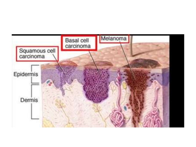 Squamous cell carcinoma, Basal cell carcinoma, Sebaceous gland carcinoma