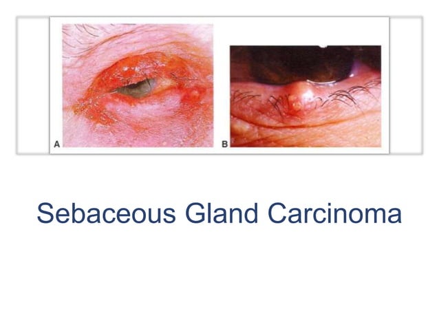 Squamous cell carcinoma, Basal cell carcinoma, Sebaceous gland carcinoma
