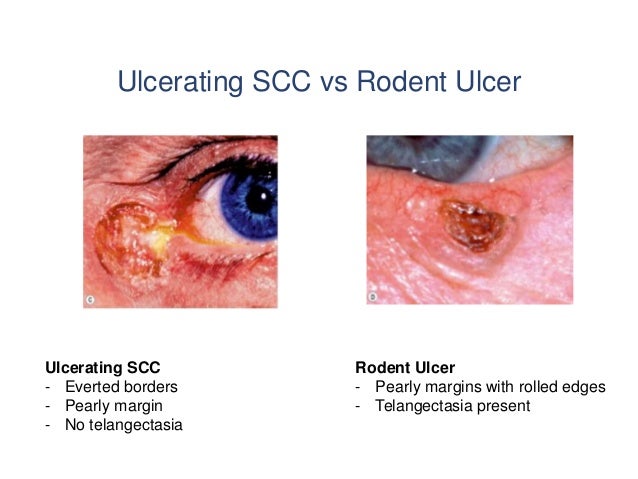 Squamous cell carcinoma, Basal cell carcinoma, Sebaceous gland carcin…