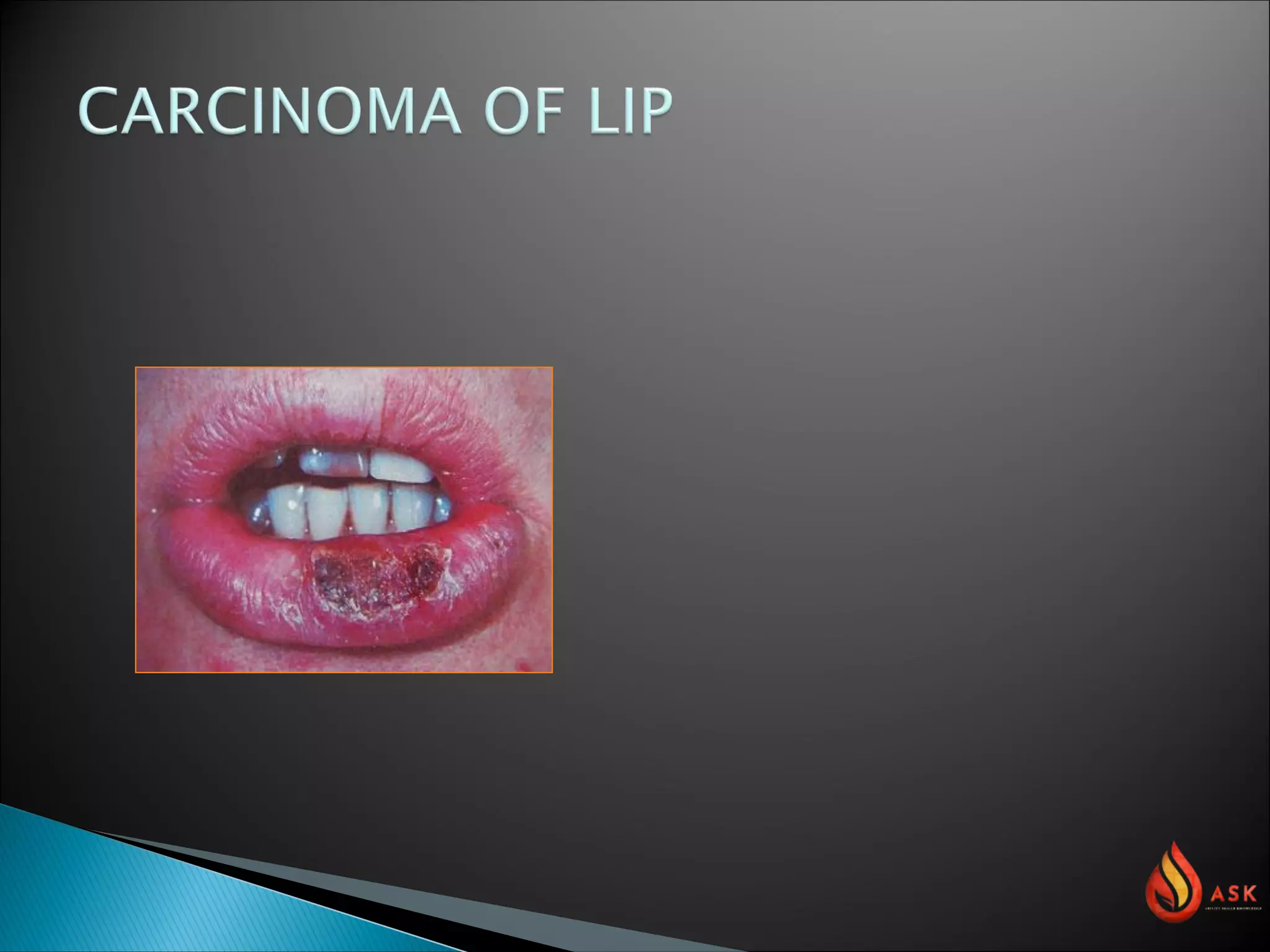 Oral Squamous Cell Carcinoma Pdf 5506