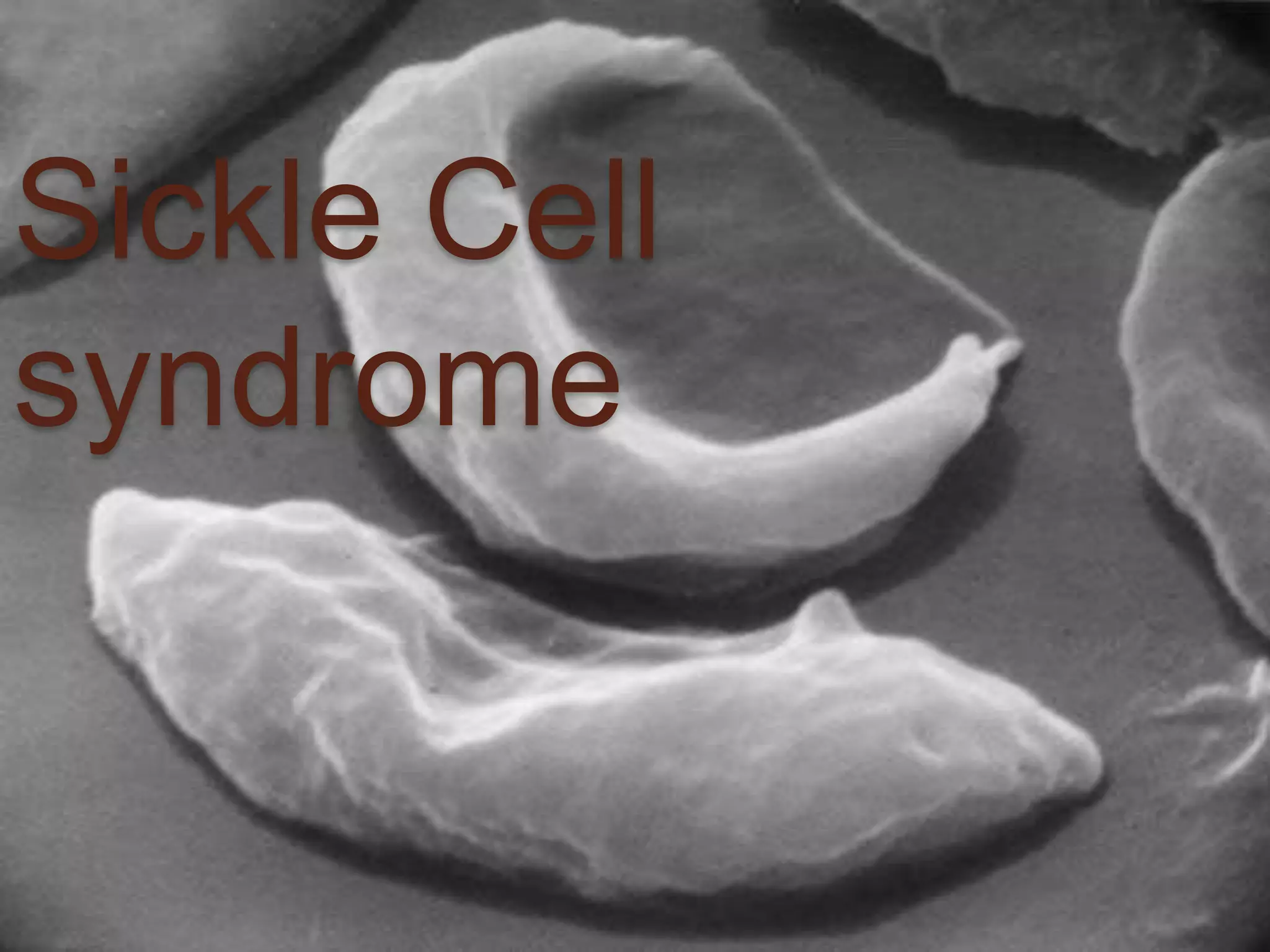 sickle cell syndrome | PPTX