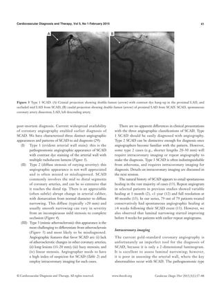 Spontaneous coronary artery dissection—A review | PDF | Heart and ...