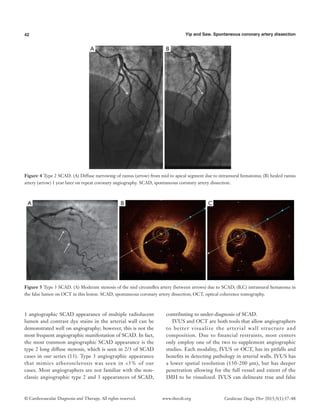 Spontaneous coronary artery dissection—A review | PDF | Heart and ...