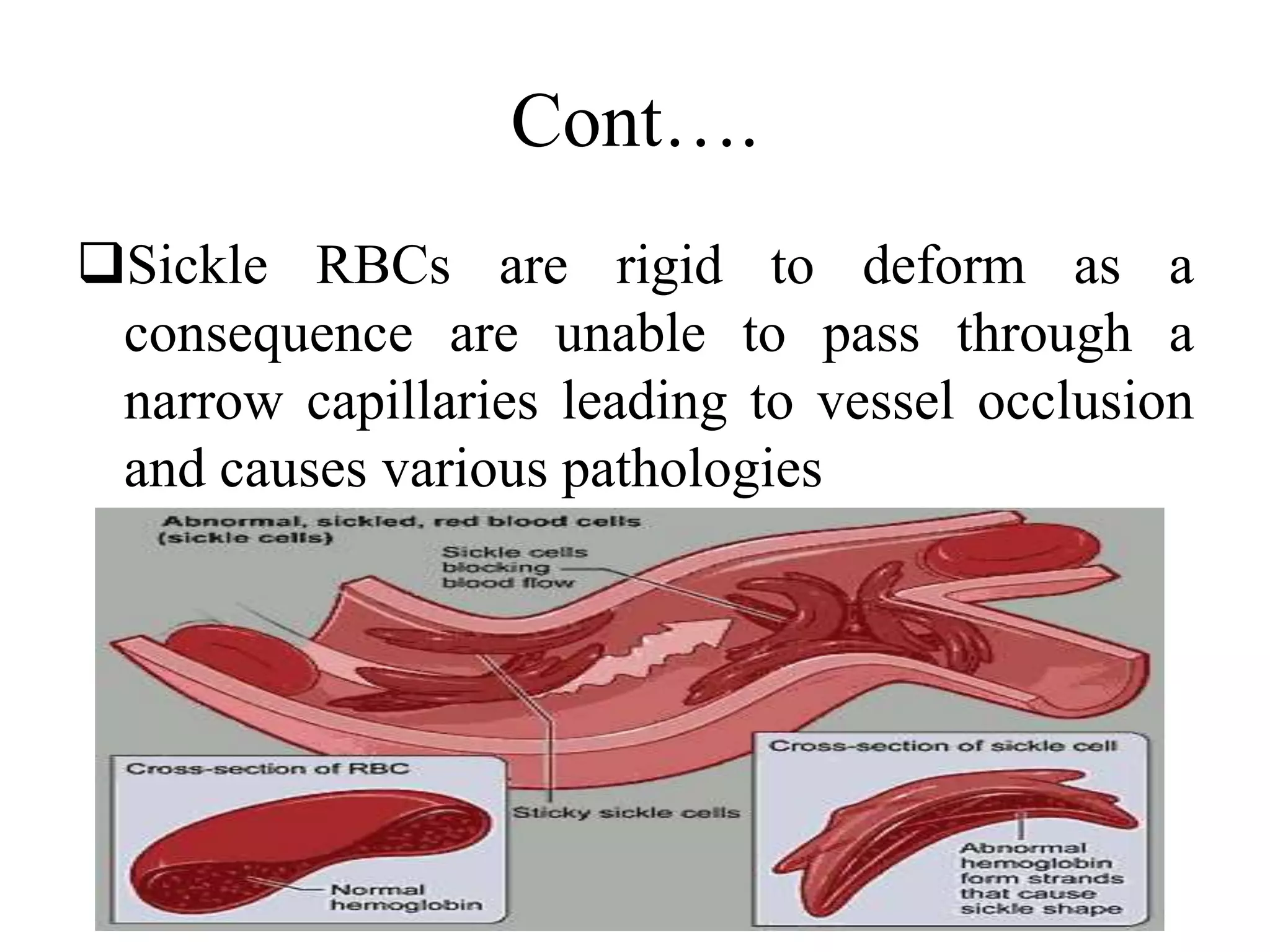 Sickle cell diseases and acute chest syndrome | PPTX