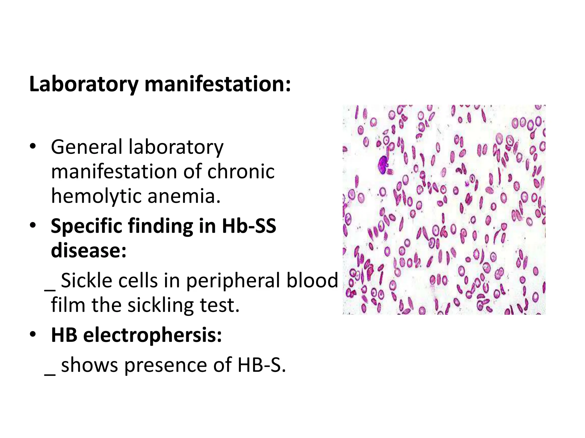 Sickle cell anemia one of the hemolytic anemias | PPTX