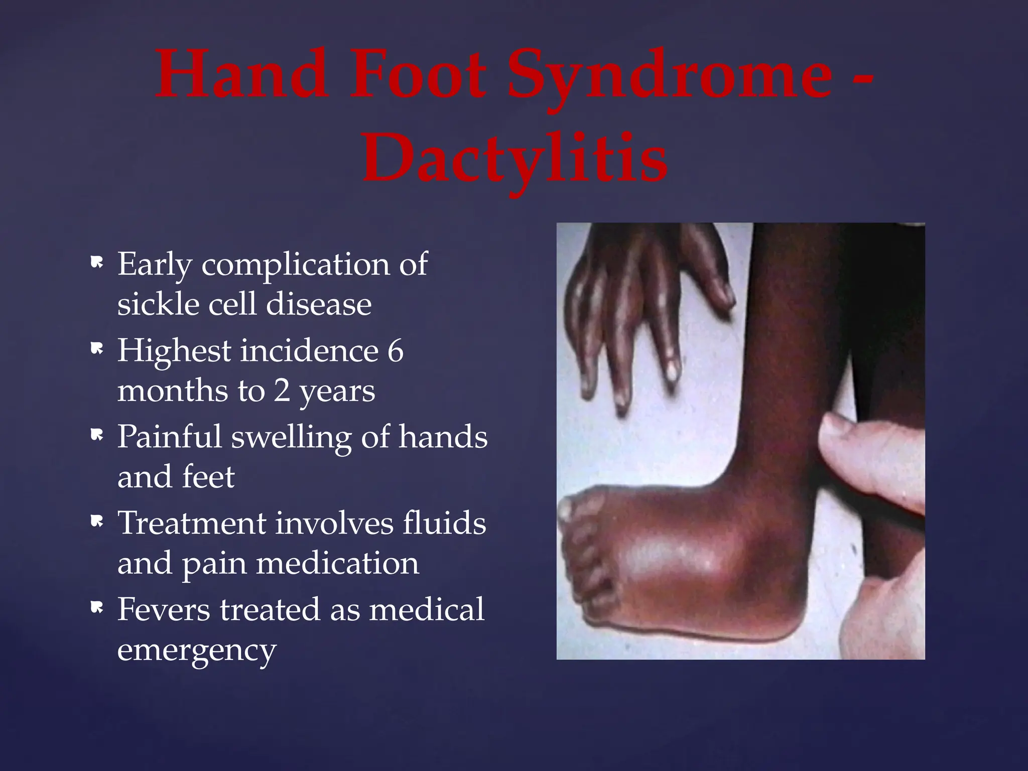 sickle cell disease management and complications | PPTX