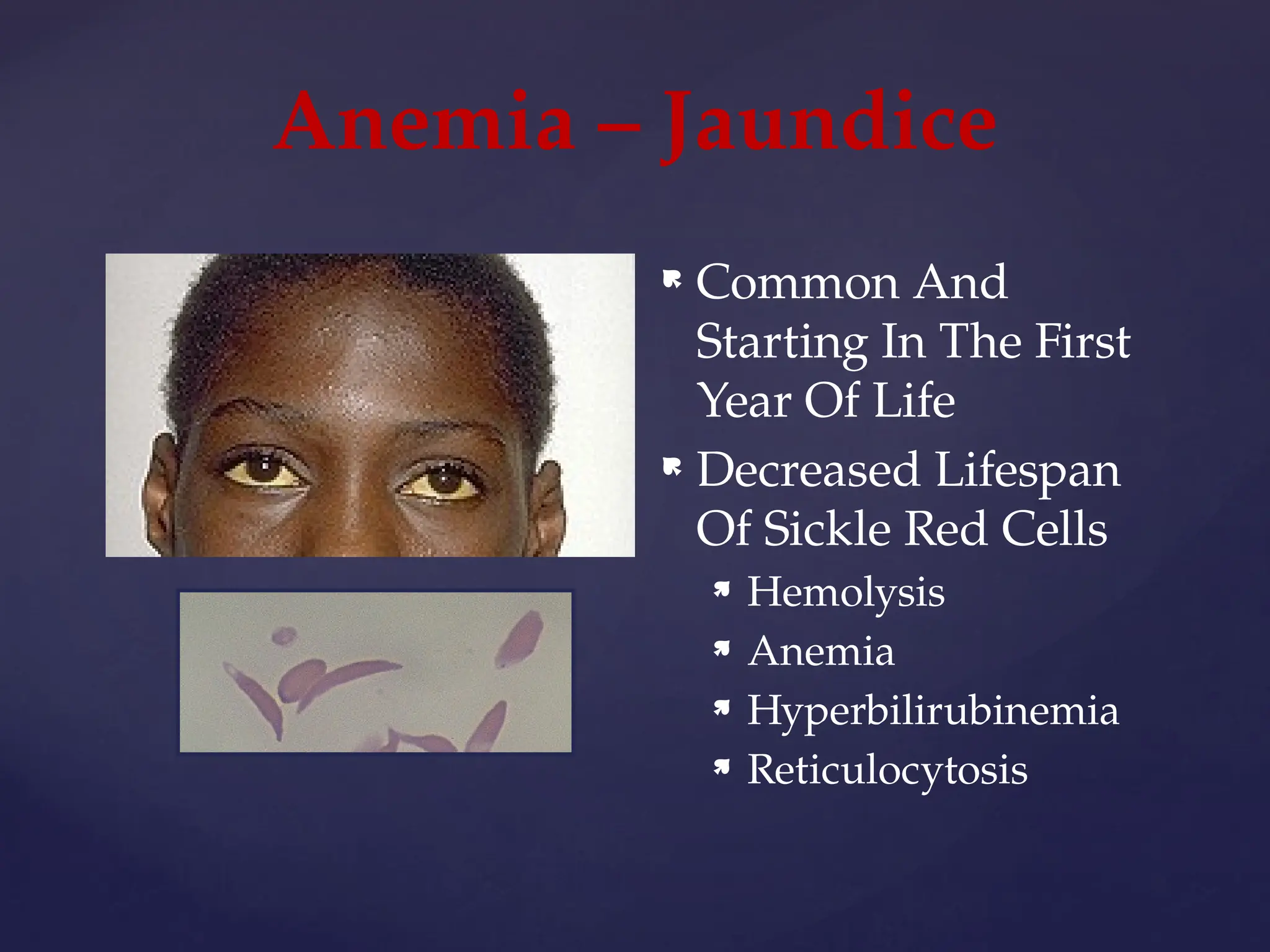 sickle cell disease management and complications | PPTX