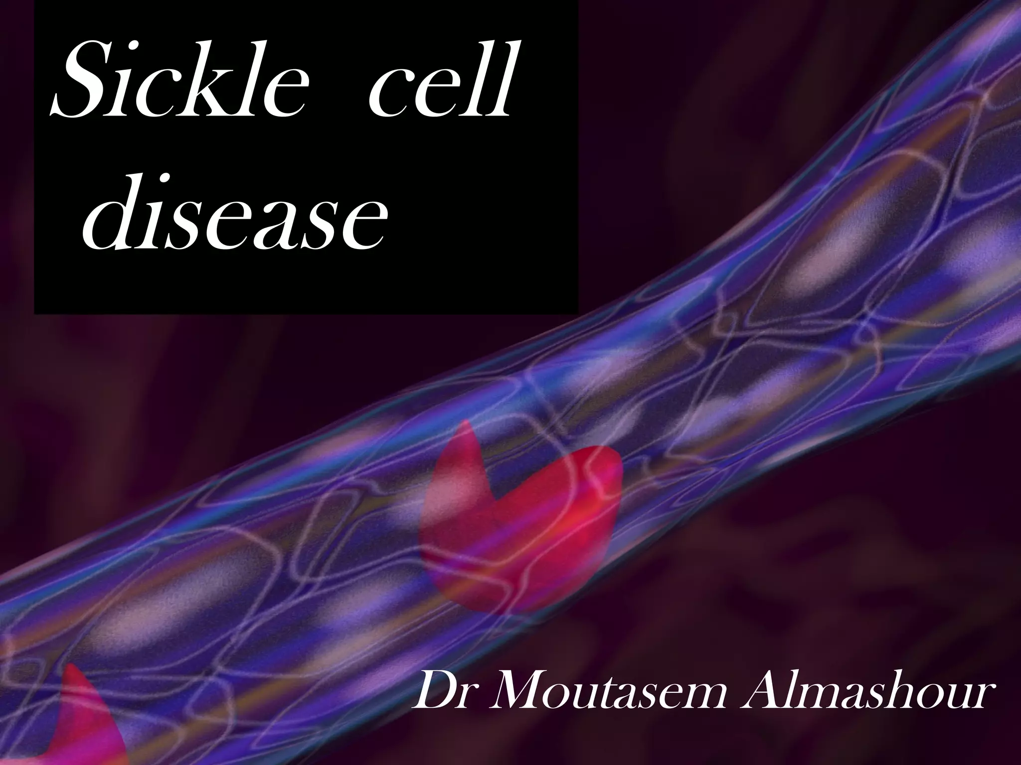 Sickle Cell Disease Ppt