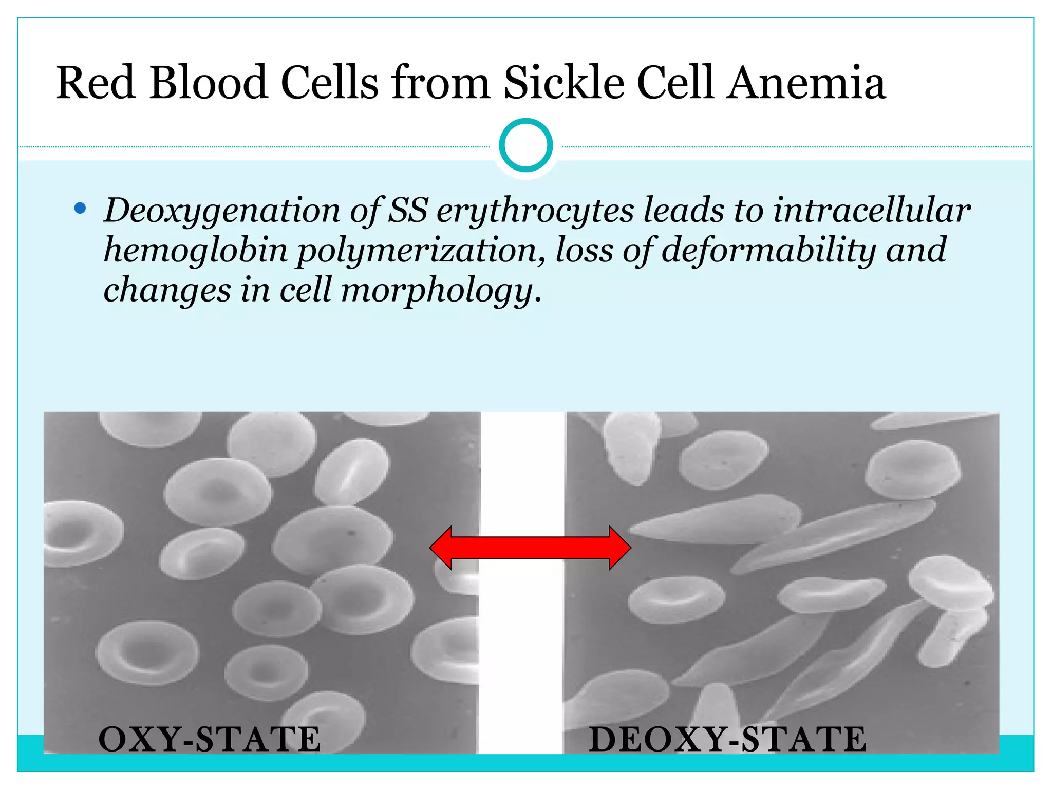 Sickle cell disease | PPT