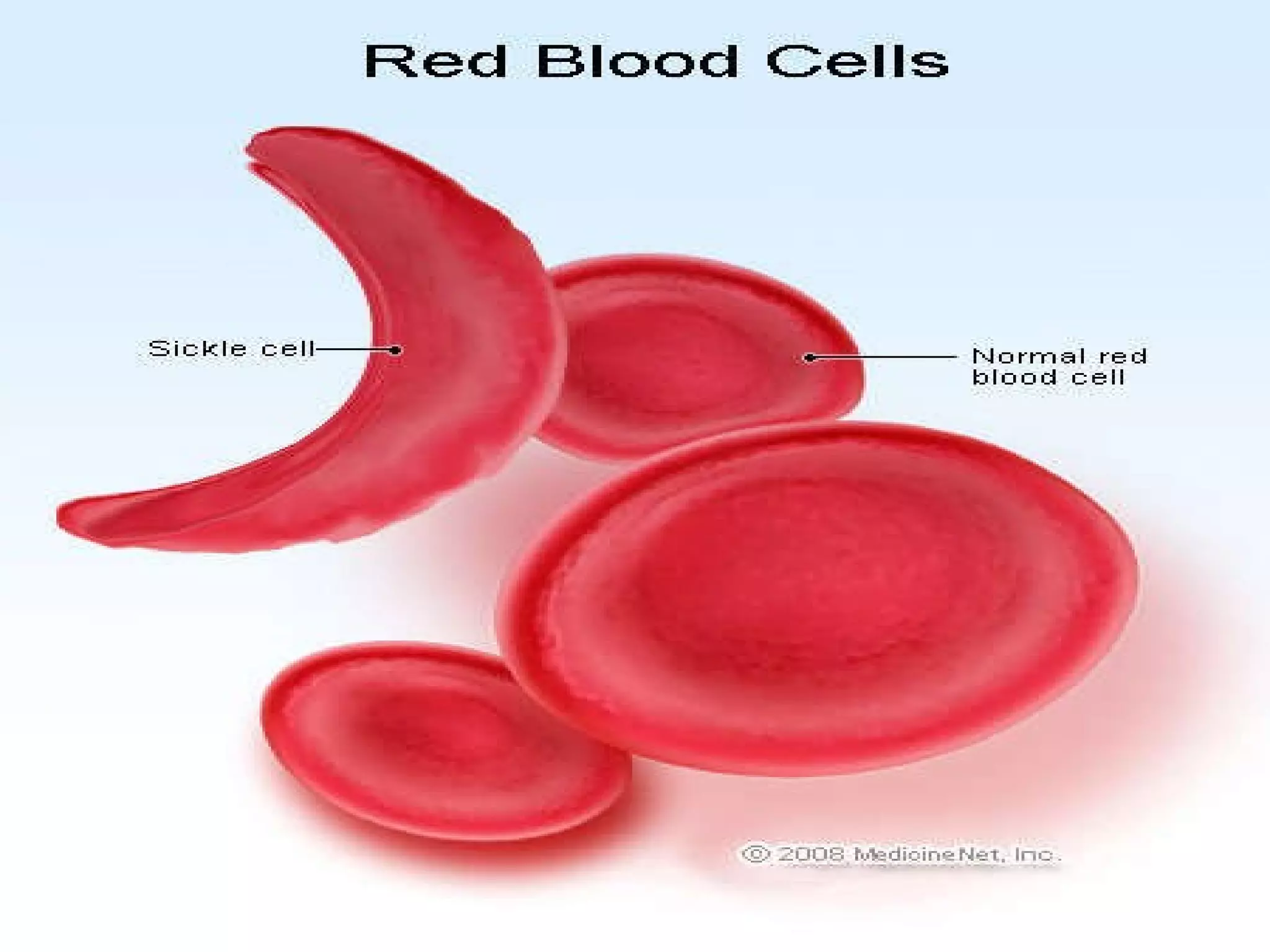 Sickle cell disease | PPT