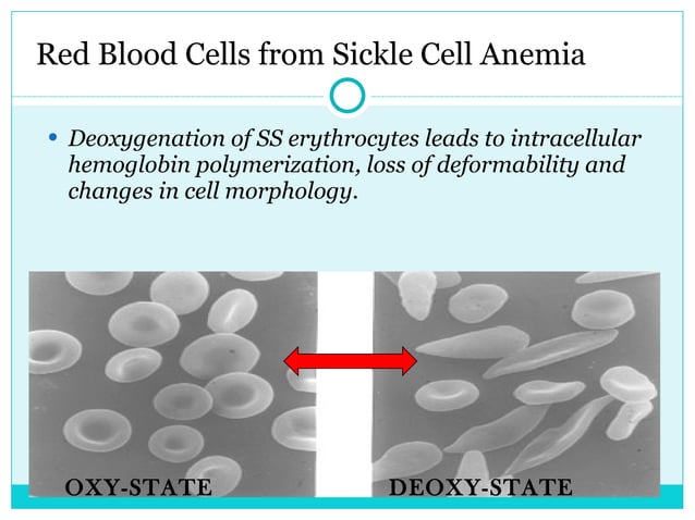 Sickle cell disease | PPT