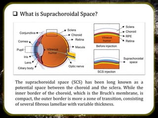 Suprachoroidal drug delivery system | PPTX