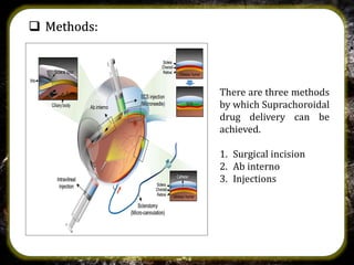 Suprachoroidal drug delivery system | PPTX | Eye and Vision Conditions ...