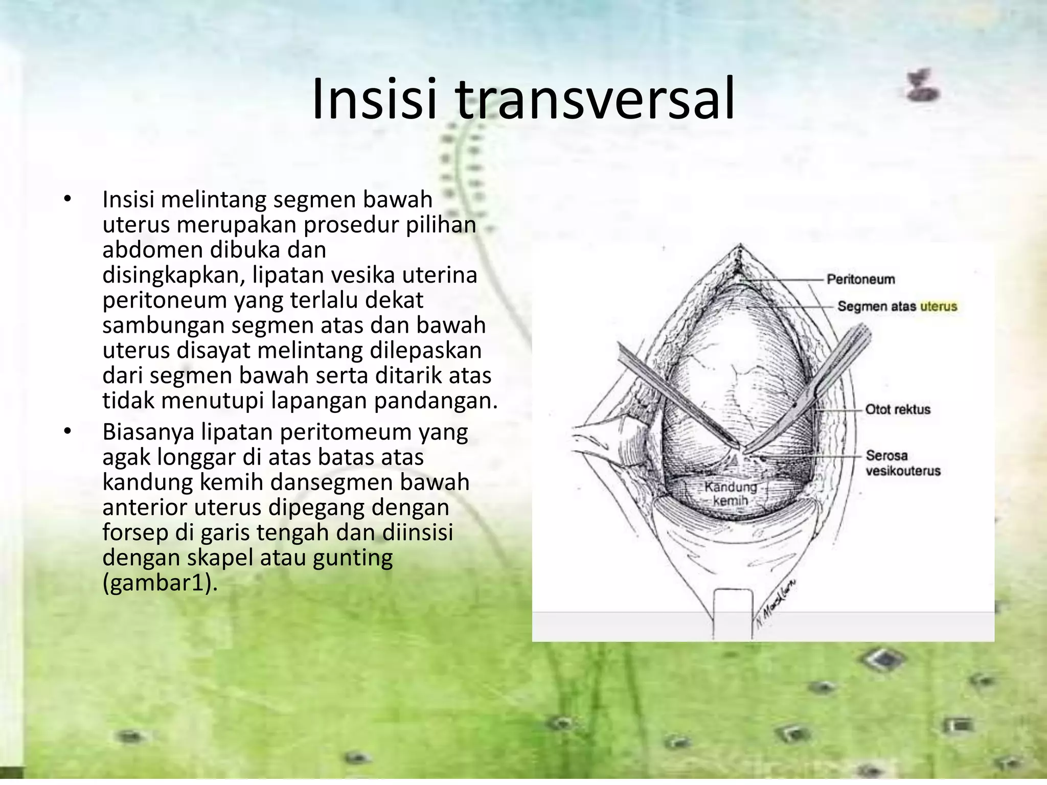 HISTEROTOMI, SALPINGEKTOMI, HISTERORAPI, SEKSIO SESAREA | PPTX
