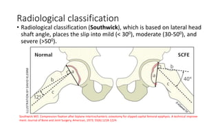 Slipped Capital Femoral Epiphysis | PPT