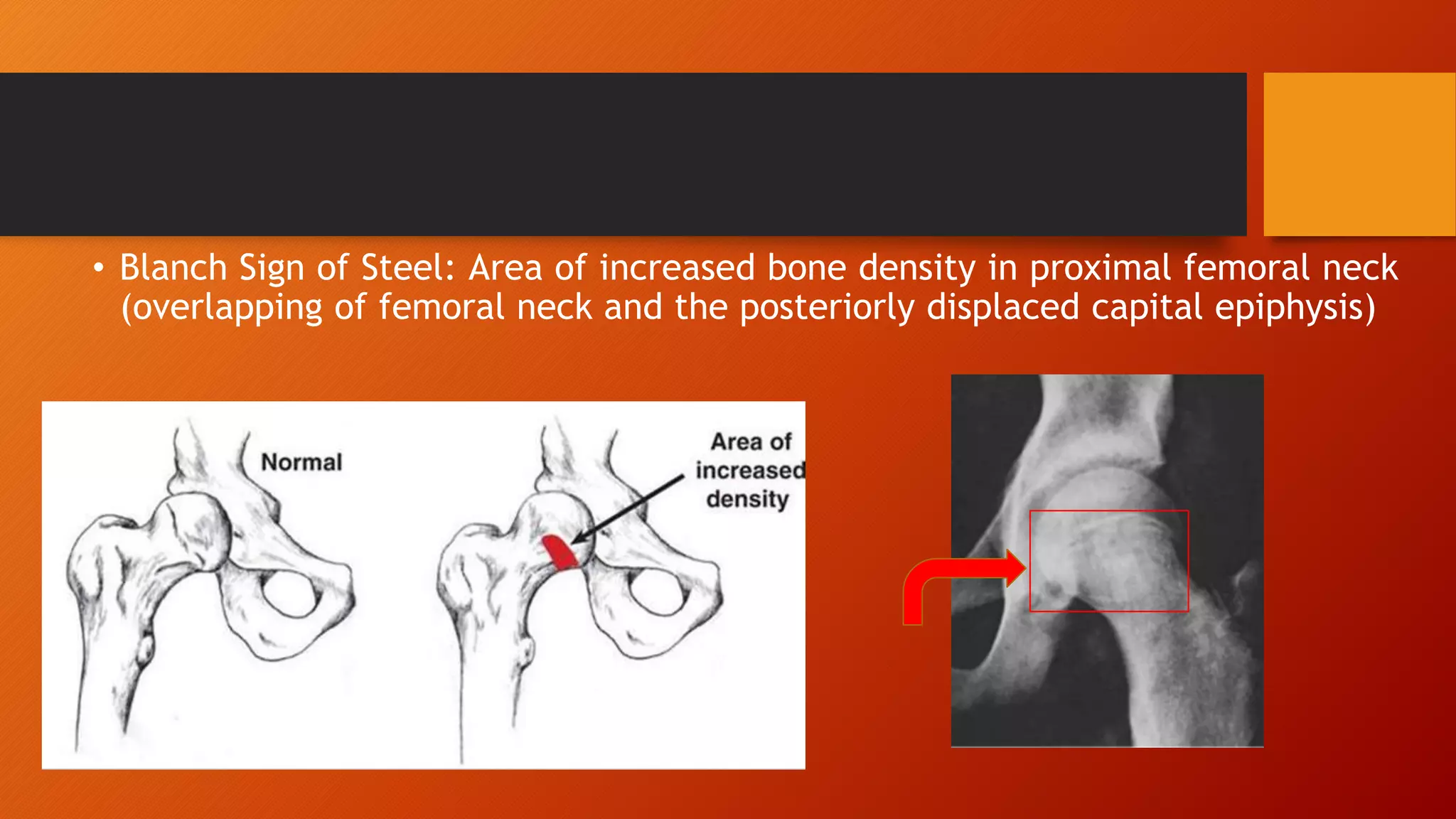 Slipped capital femoral epiphysis | PPT