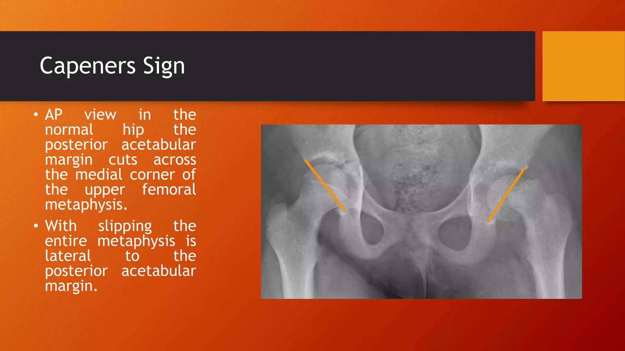Slipped capital femoral epiphysis | PPT