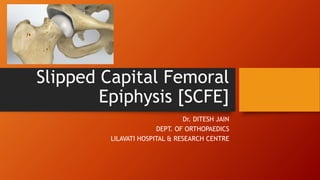 Slipped capital femoral epiphysis | PPT