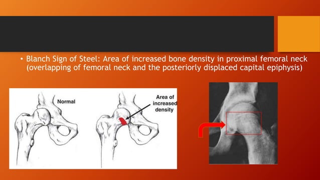 Slipped capital femoral epiphysis | PPT