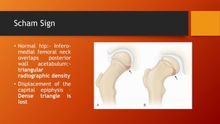 Slipped capital femoral epiphysis | PPT