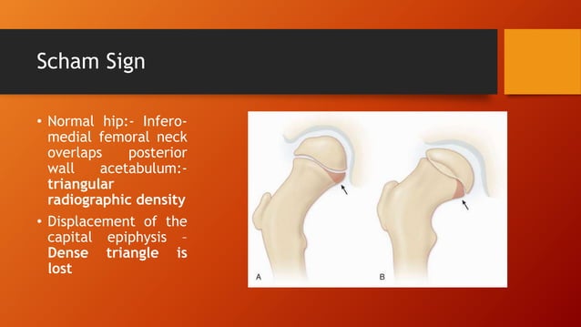 Slipped capital femoral epiphysis | PPT
