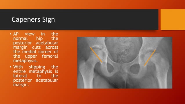Slipped capital femoral epiphysis | PPT
